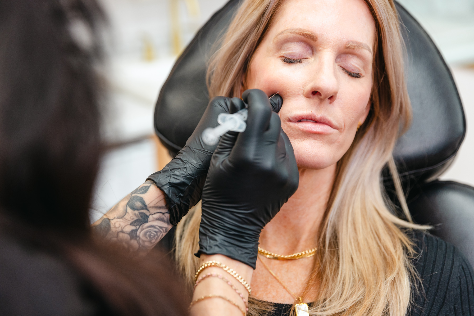 Sculptra in Sioux City | Lace & Needle